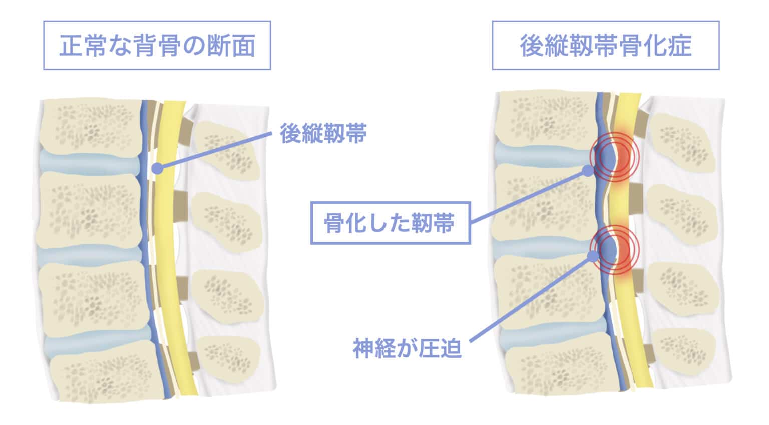 後縦靱帯骨化症が治った！足指と姿勢改善で症状を自力で克服した体験談｜手術なしの改善方法を徹底解説